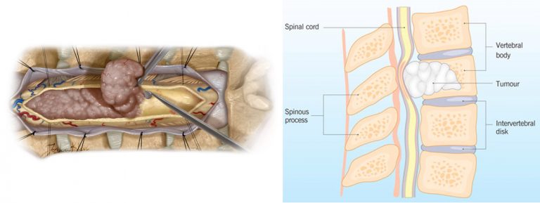 Spinal tumor excision reconstruction surgery treatment in Mumbai